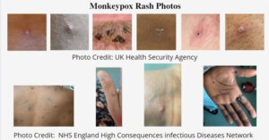Monkeypox Disease, Symptoms, prevention, and Transmission
